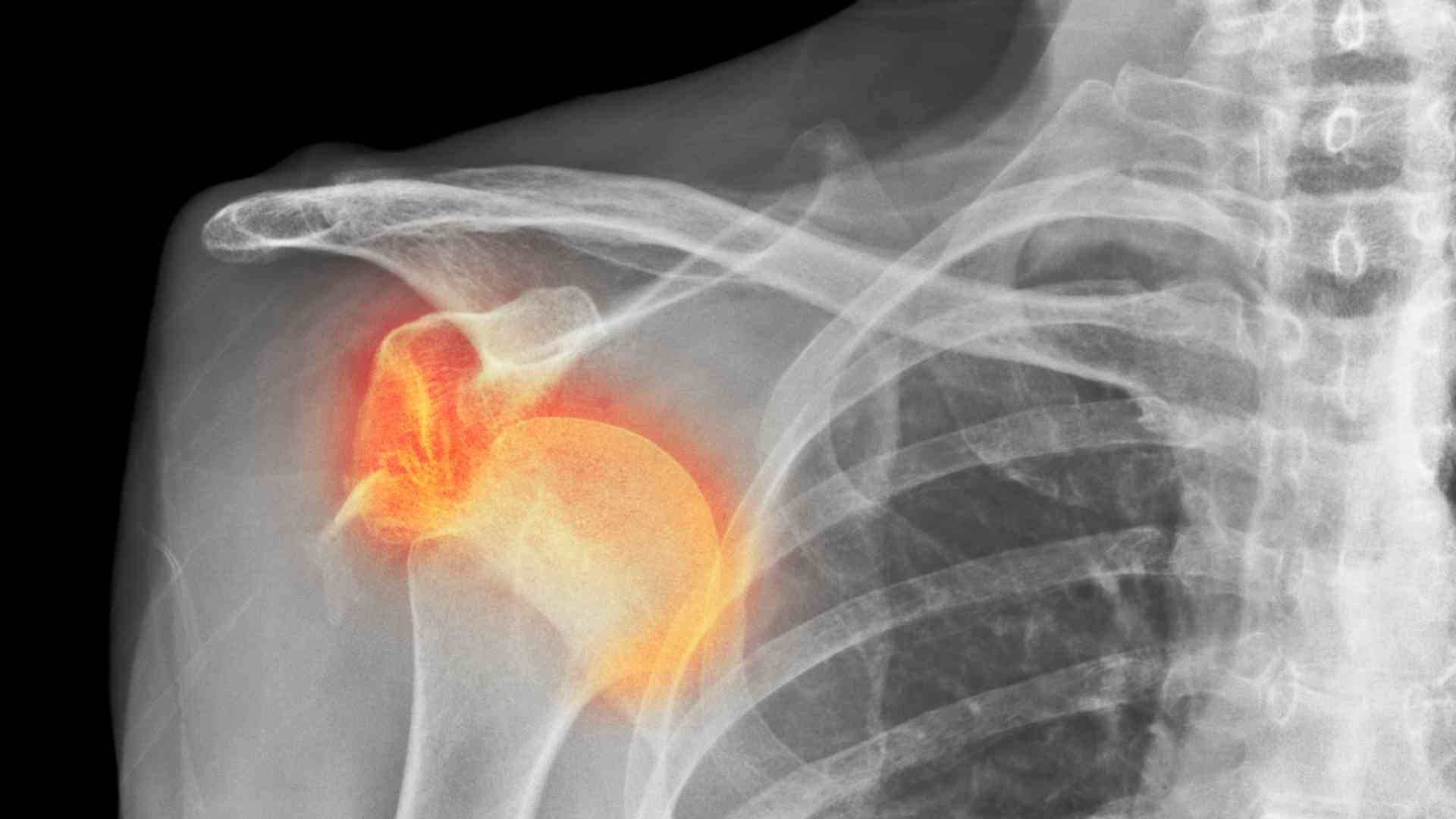 Best AC Joint Fixation Surgery in Hyderabad | #1 Dr Praful Kilaru