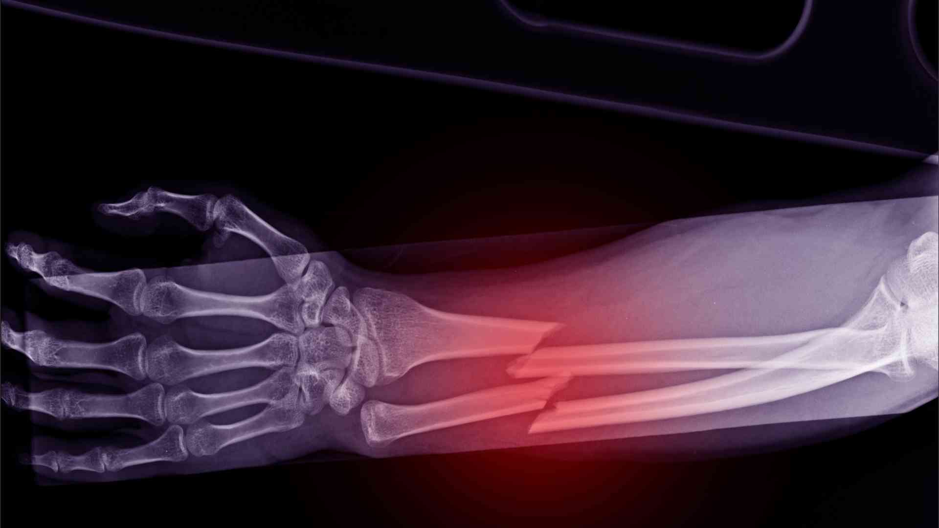 Best Complex Fracture Treatment in Hyderabad |#1 Expert Care
